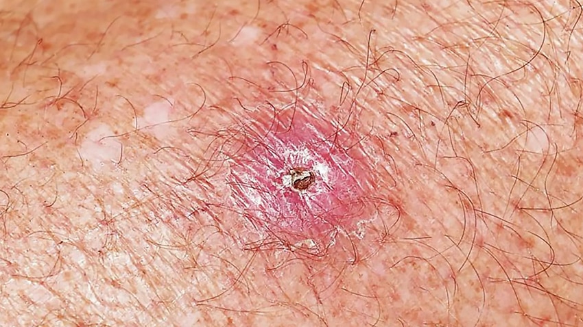 SBS Language | Flesh-eating Buruli ulcer spreading rapidly in Australia SBS Language | Flesh-eating Buruli ulcer spreading rapidly in Australia